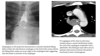 IMAGING IN ESOPHAGEAL PATHOLOGIES.p.....ptx
