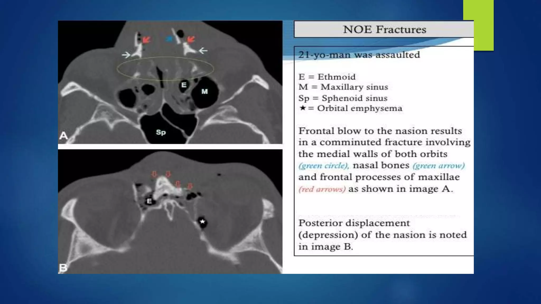 Imaging in facial trauma | PPTX