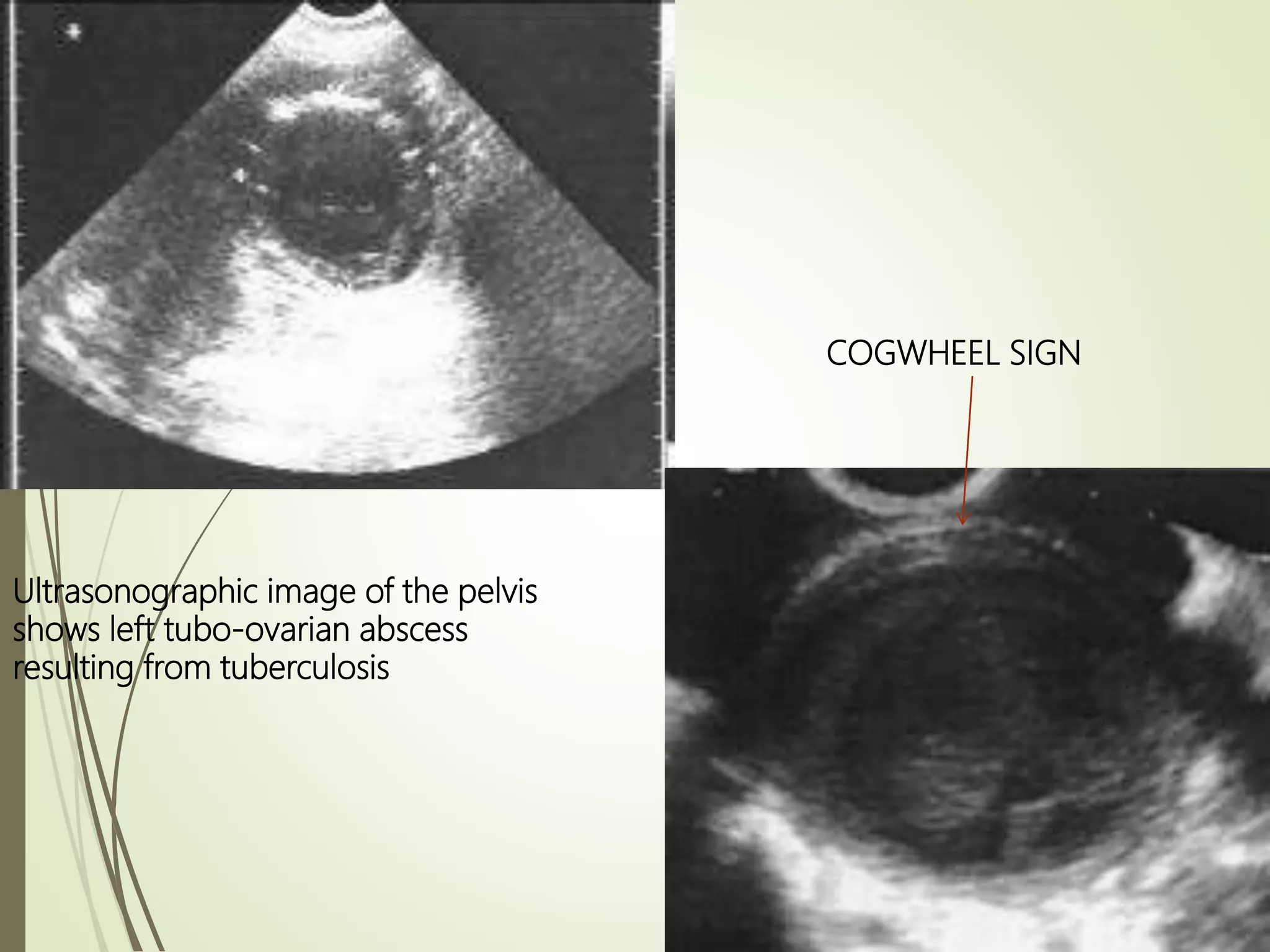 Imaging in female infertility | PPTX