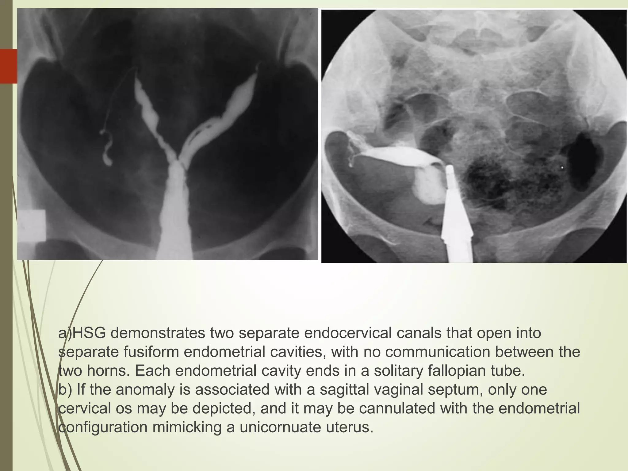 Imaging in female infertility | PPTX