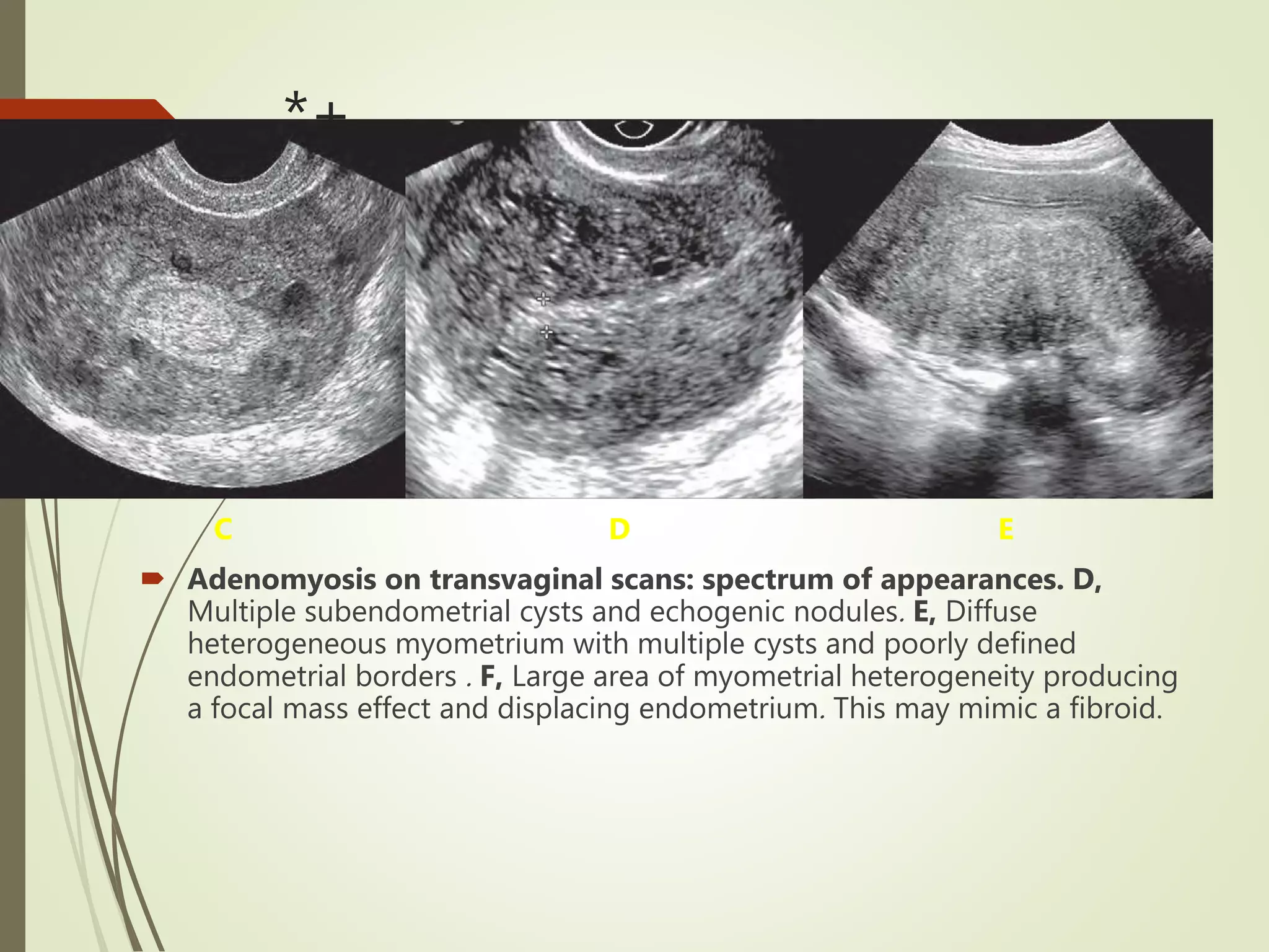 Imaging in female infertility | PPTX