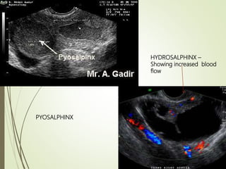 Imaging in female infertility | PPTX