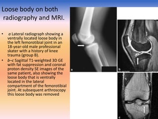 Imaging in fractures | PPTX