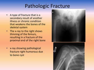 Pathologic Fracture X Ray
