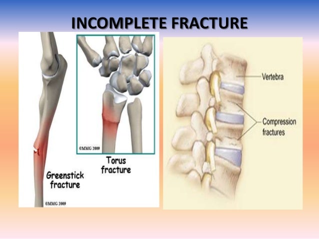 What Is An Incomplete Fracture _ Fracture Multifragmentaire – KAZJT