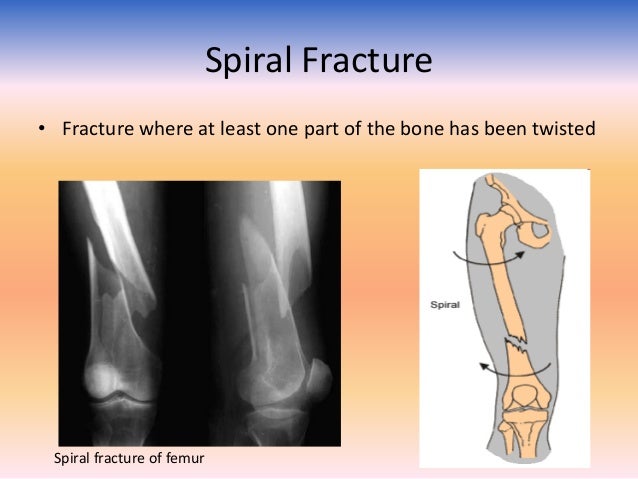 Imaging in fractures