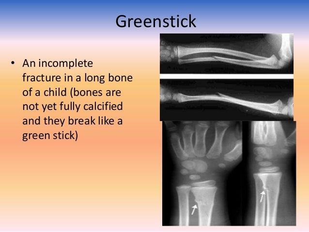 Greenstick Fracture Clavicle