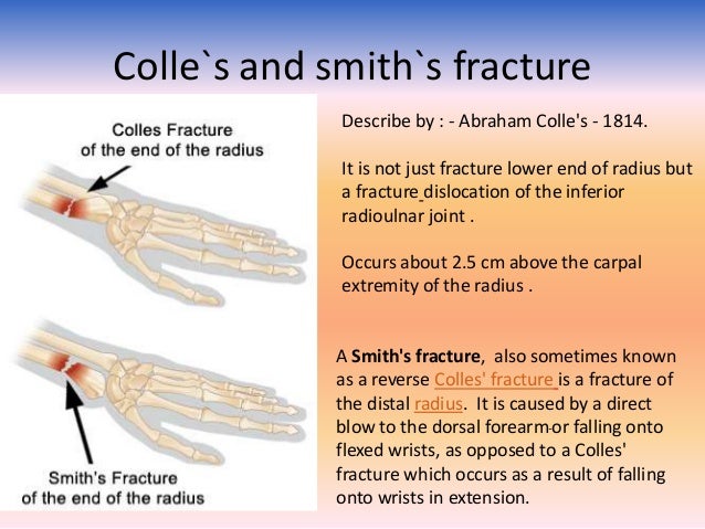 Smith Fracture Radiology