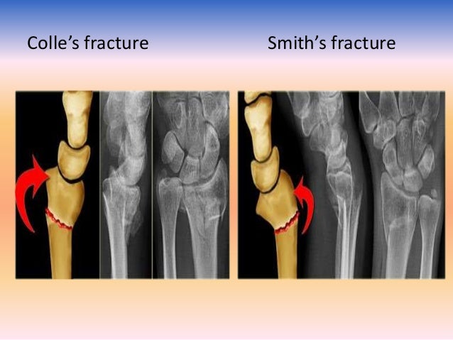 Imaging in fractures