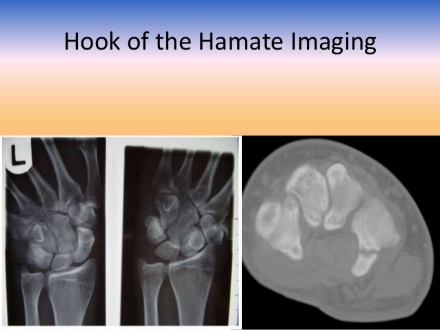 Imaging in fractures