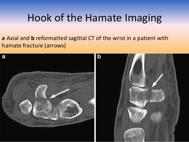 Imaging in fractures