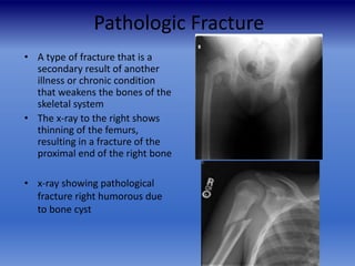 Pathologic Fracture X Ray