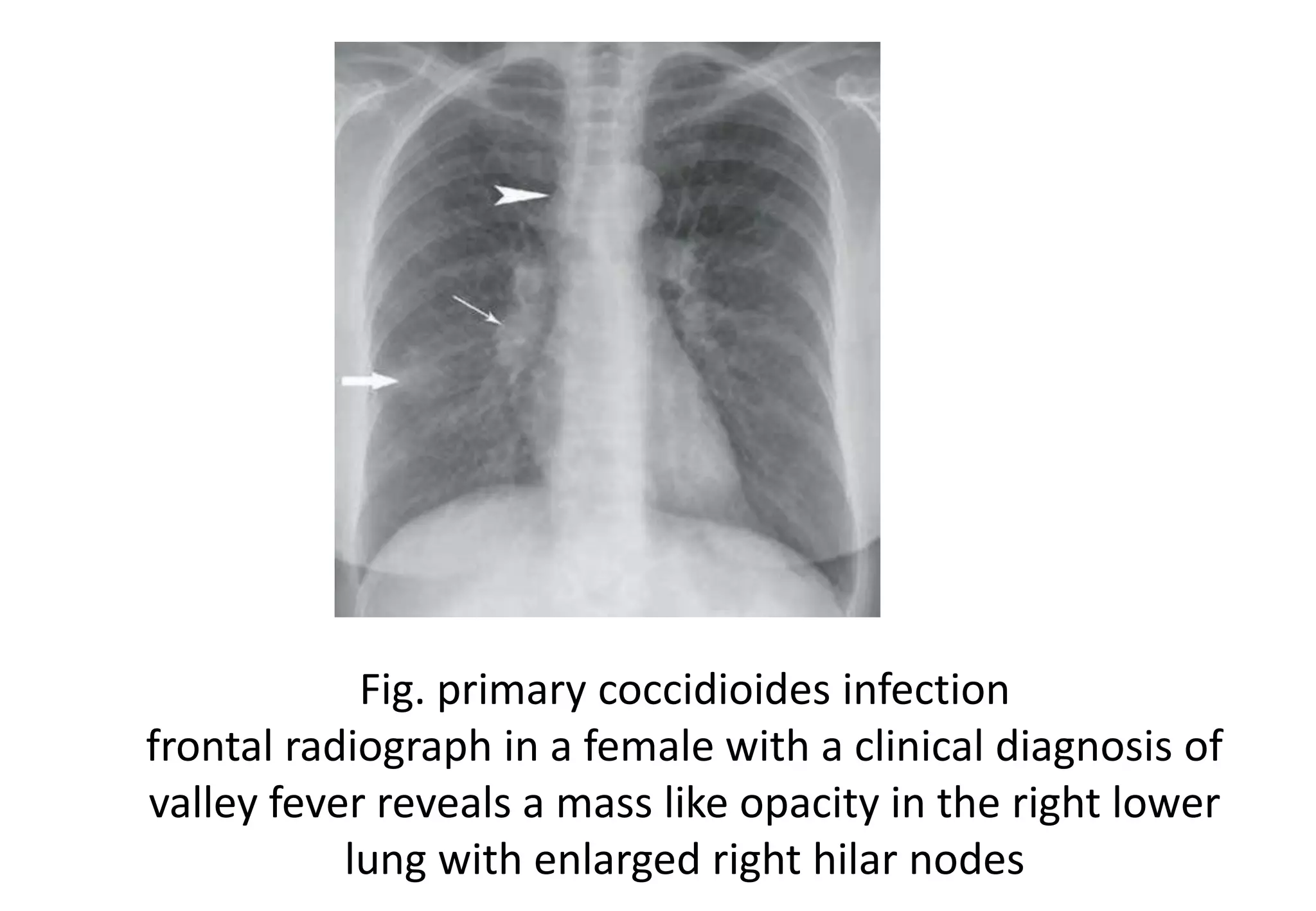 Imaging in fungal infection of chest | PPTX