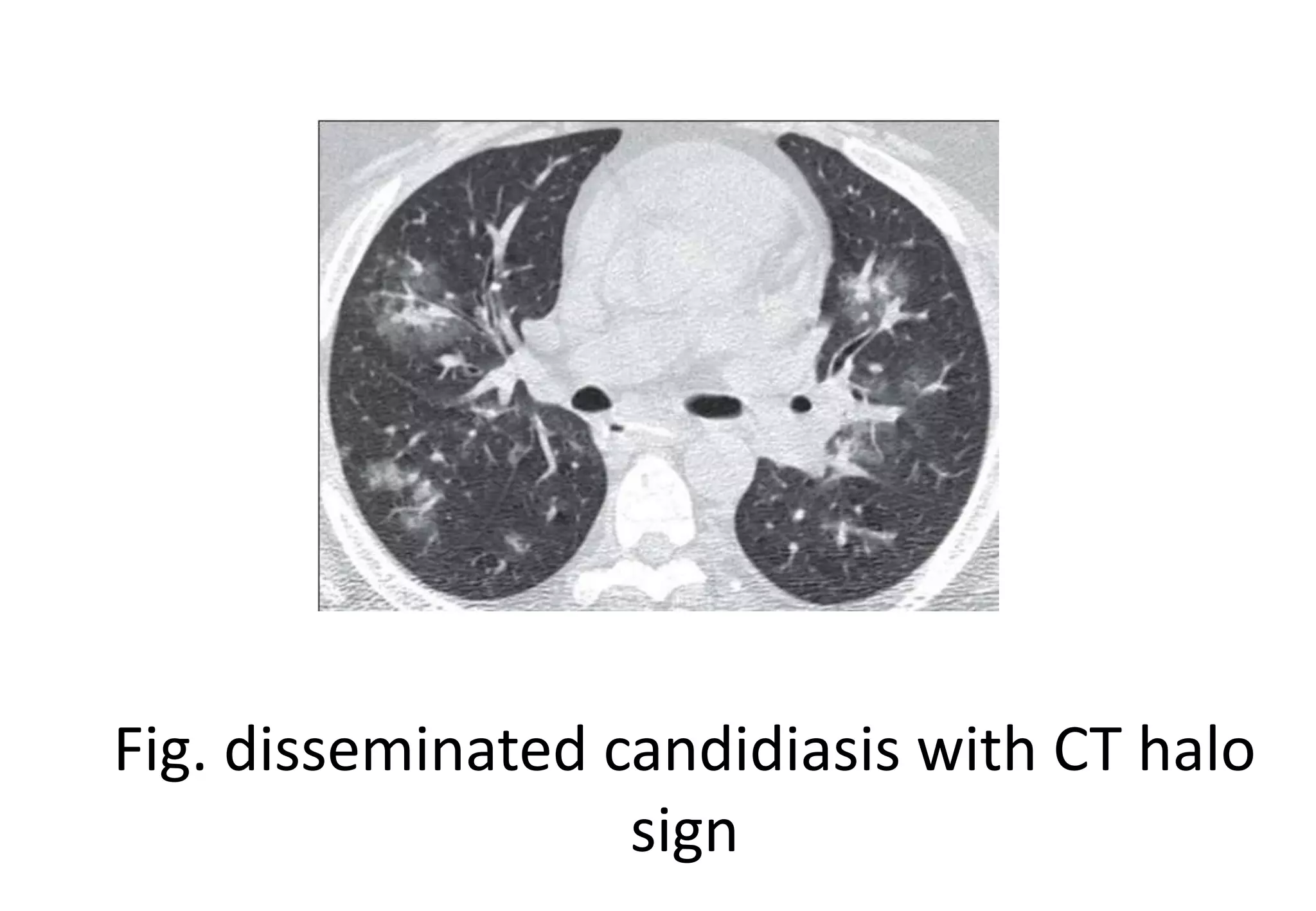Imaging in fungal infection of chest | PPTX