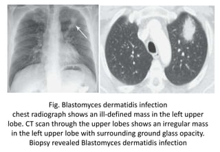 Imaging in fungal infection of chest | PPTX