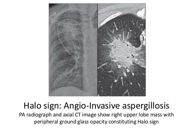 Imaging in fungal infection of chest