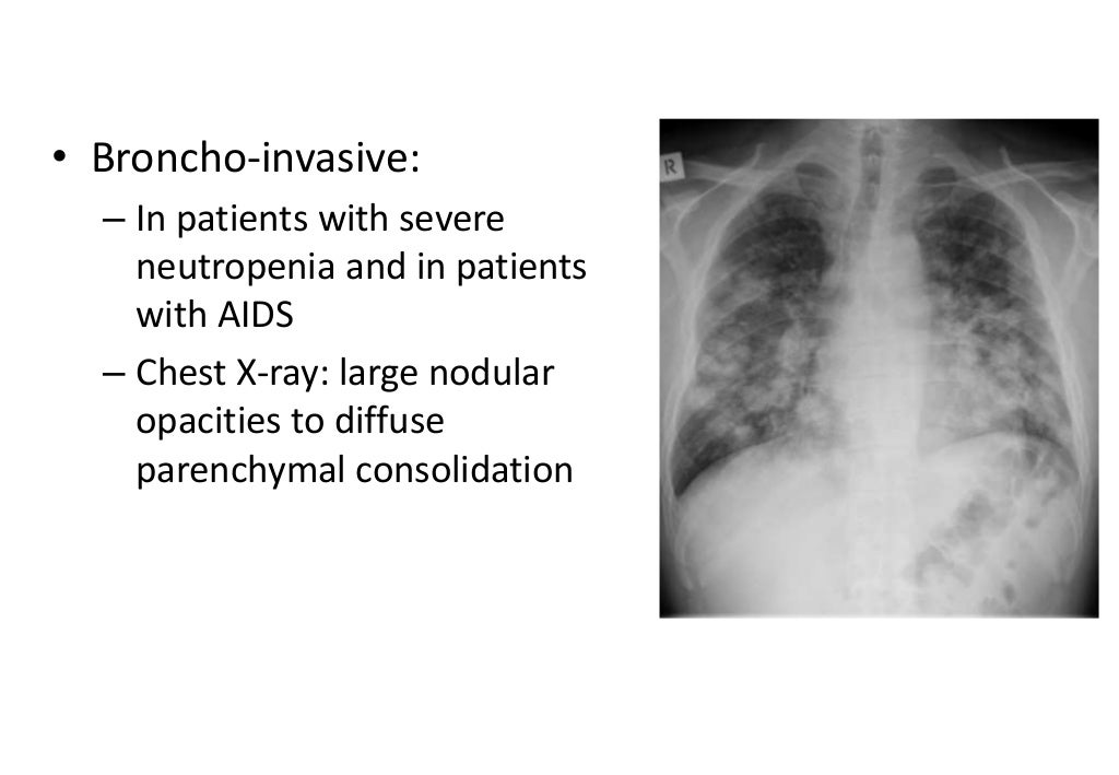 Imaging In Fungal Infection Of Chest