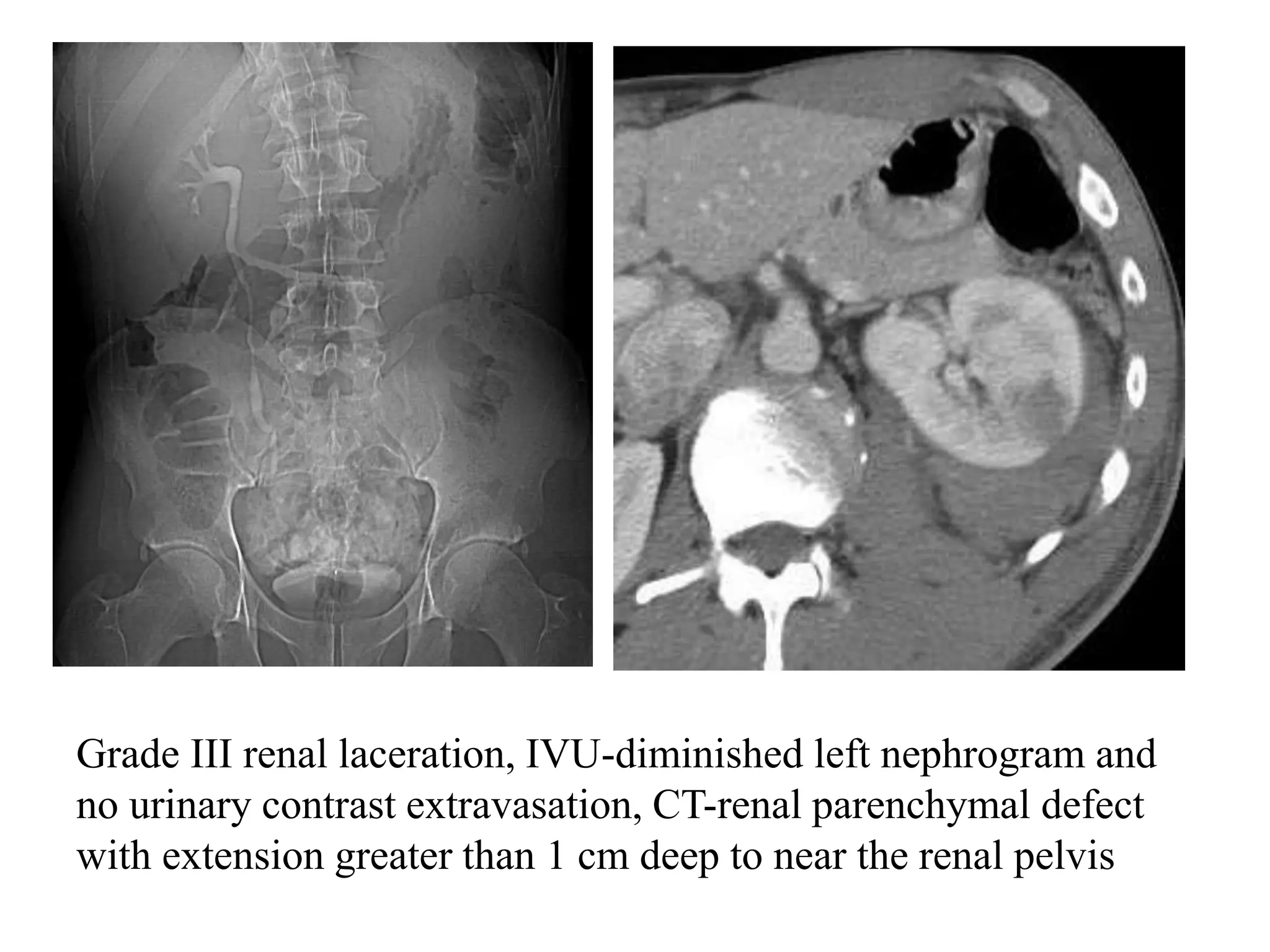 Imaging in genitourinary trauma | PPT