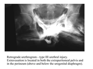 Imaging in genitourinary trauma | PPT