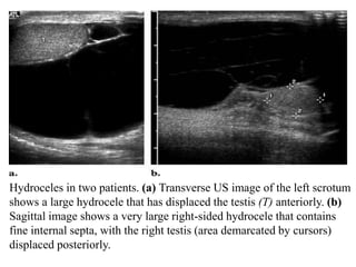 Imaging in genitourinary trauma | PPT