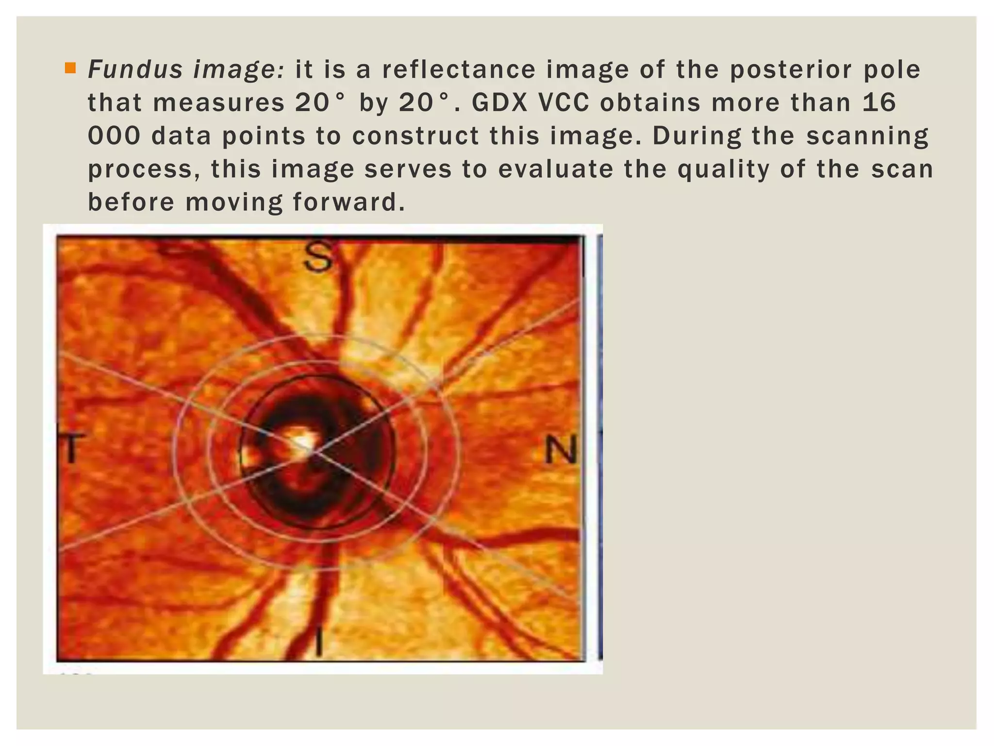 Imaging in glaucoma | PPTX