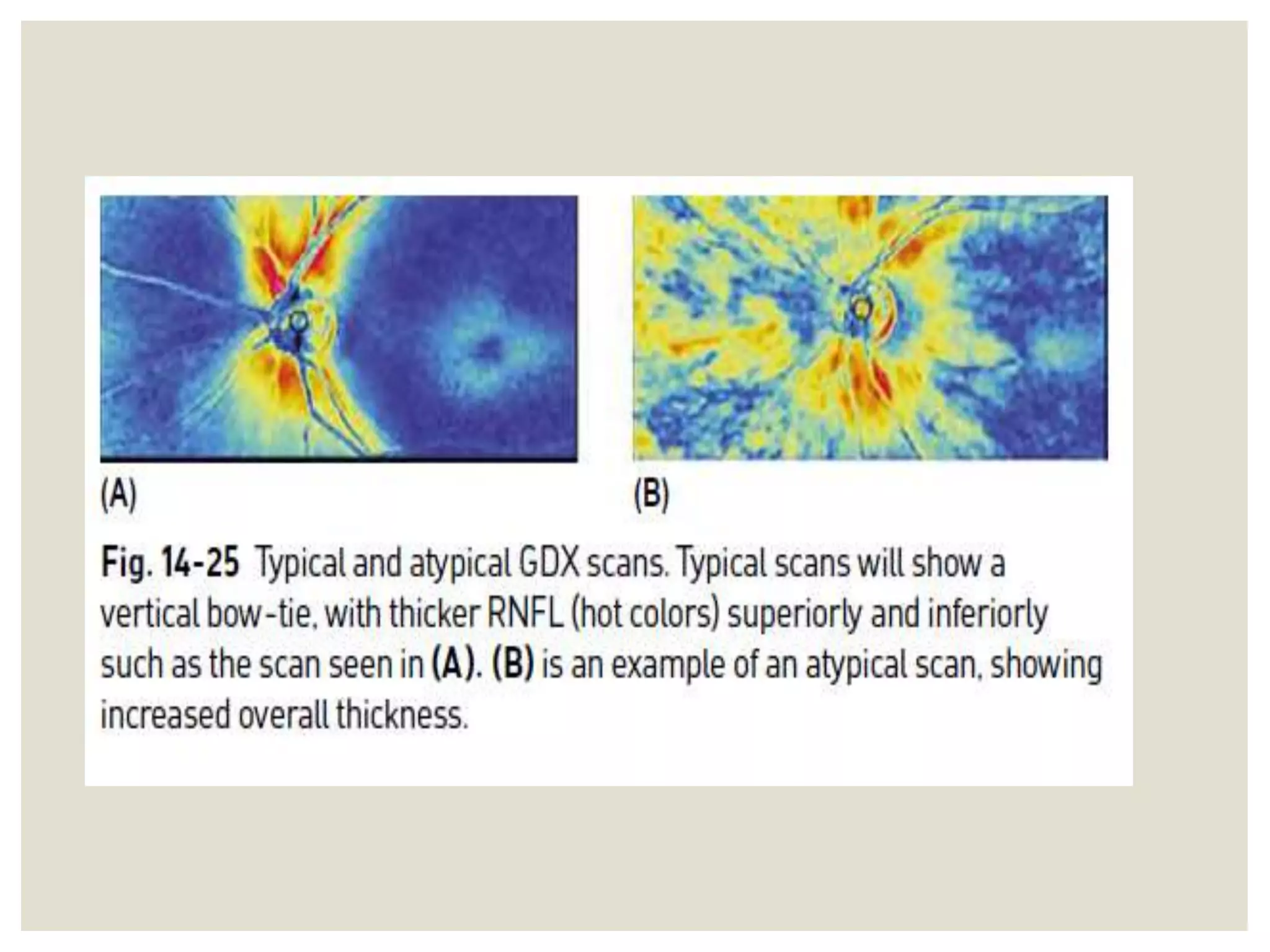 Imaging in glaucoma | PPTX | Eye and Vision Conditions | Diseases and ...