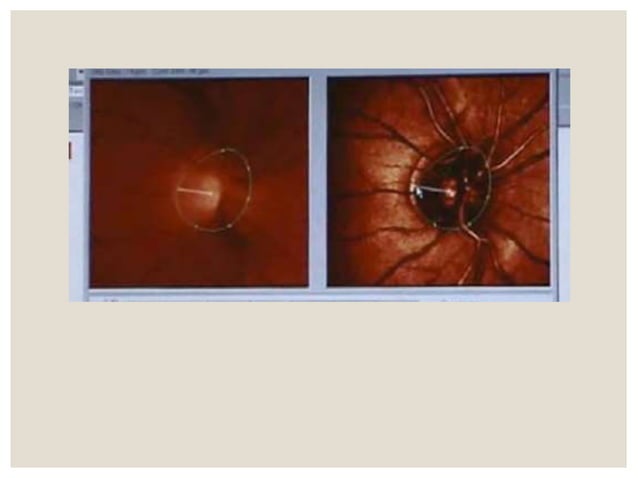 Imaging in glaucoma | PPTX | Eye and Vision Conditions | Diseases and ...