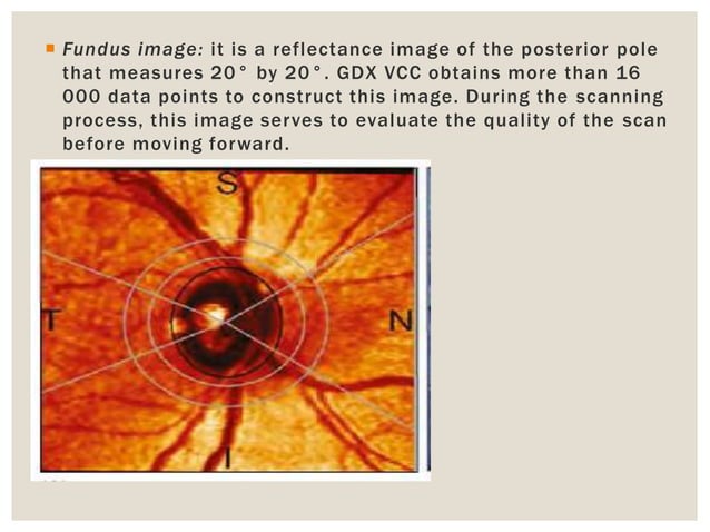 Imaging in glaucoma | PPTX | Eye and Vision Conditions | Diseases and ...