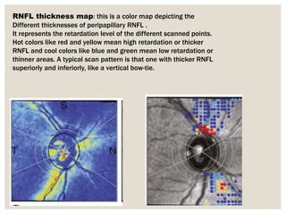 Imaging in glaucoma | PPTX