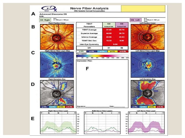 Imaging in glaucoma | PPTX | Eye and Vision Conditions | Diseases and ...