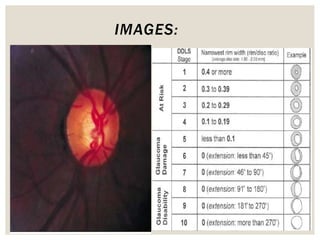 Imaging in glaucoma | PPTX