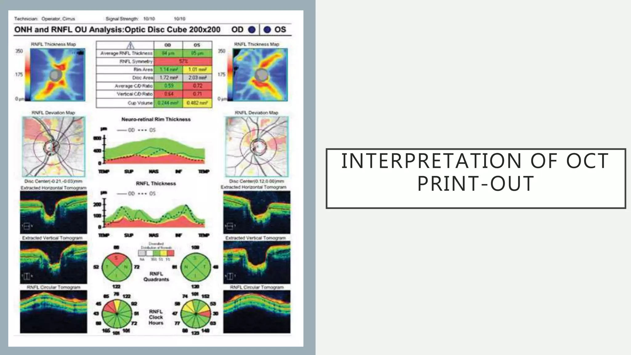 Imaging in Glaucoma | PPTX
