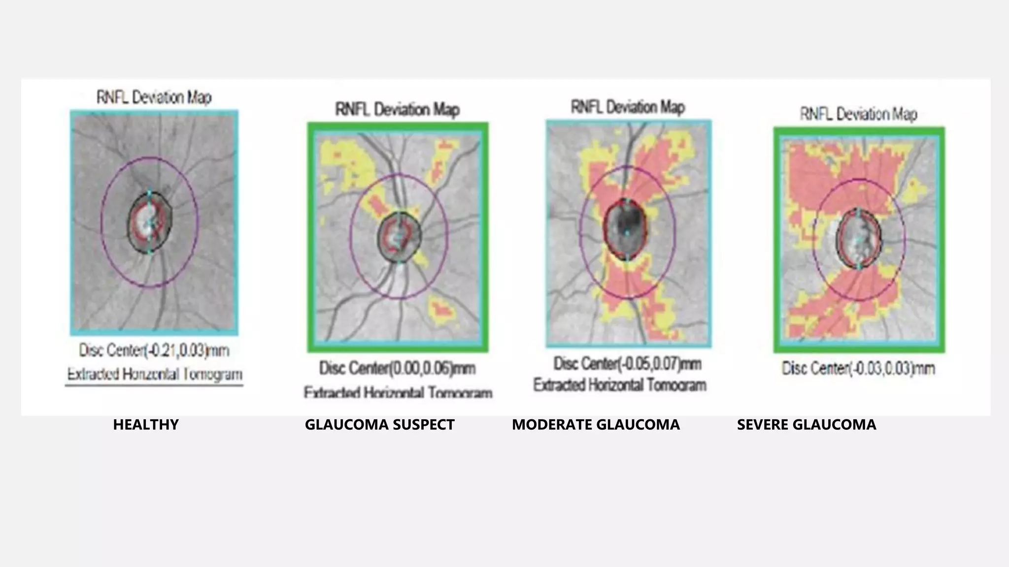 Imaging in Glaucoma | PPTX