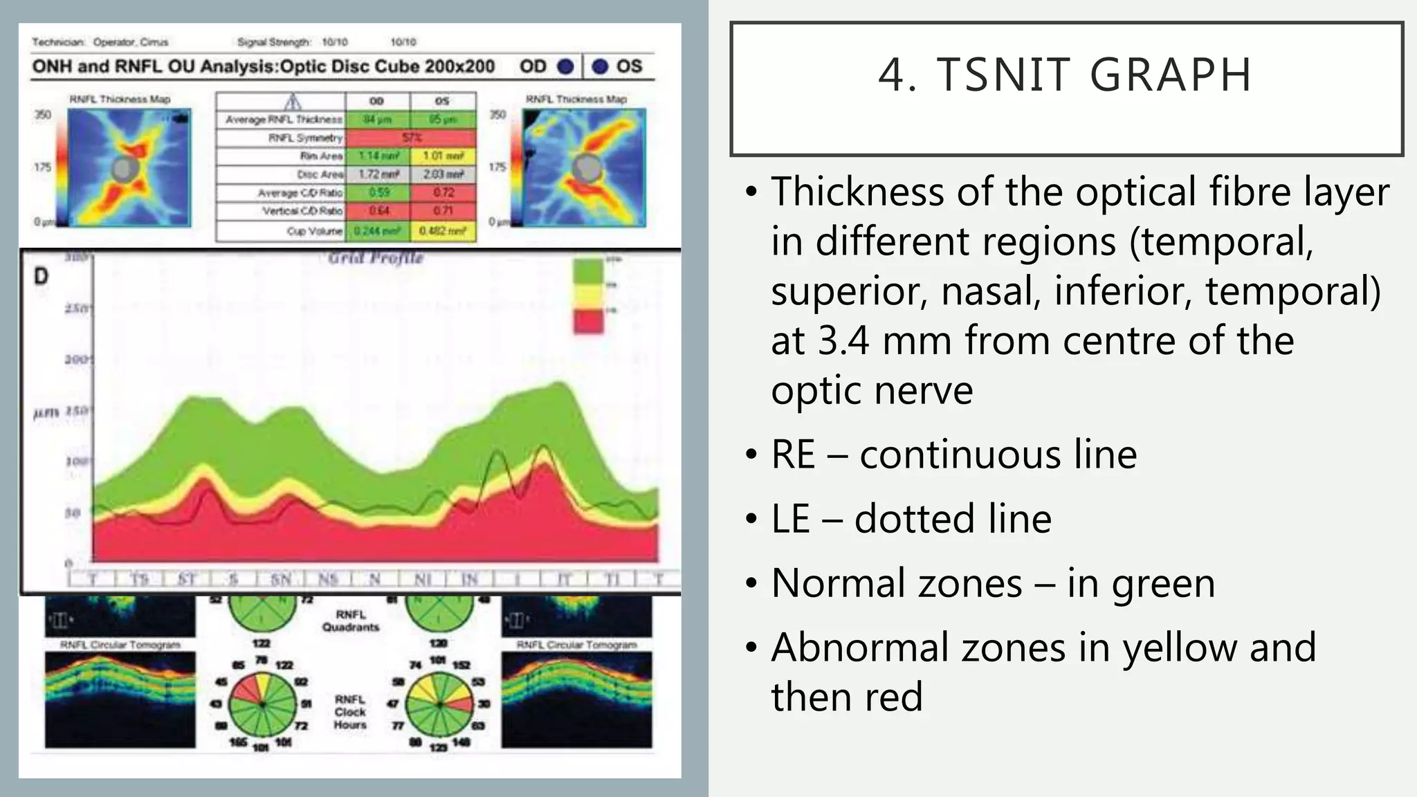 Imaging in Glaucoma | PPTX