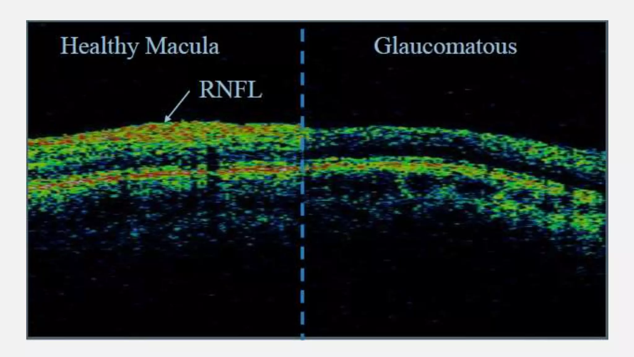 Imaging in Glaucoma | PPTX