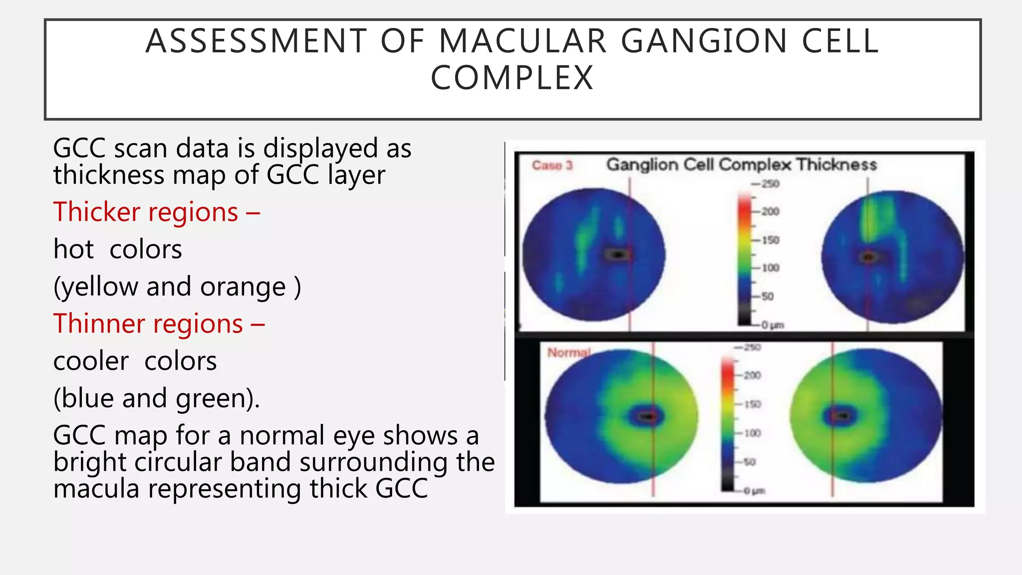 Imaging in Glaucoma | PPTX | Eye and Vision Conditions | Diseases and ...