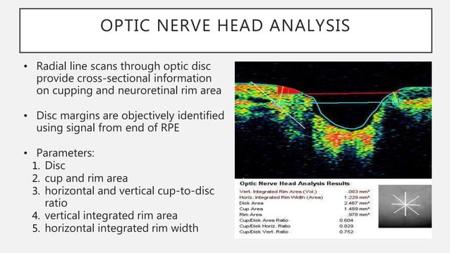Imaging in Glaucoma | PPTX | Eye and Vision Conditions | Diseases and ...