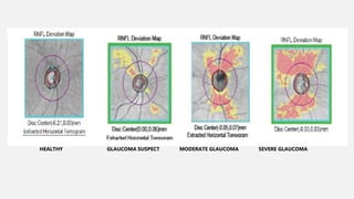 Imaging in Glaucoma | PPTX