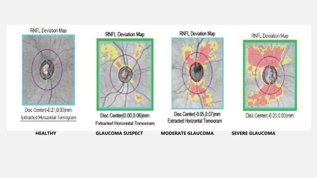 Imaging in Glaucoma | PPTX | Eye and Vision Conditions | Diseases and ...