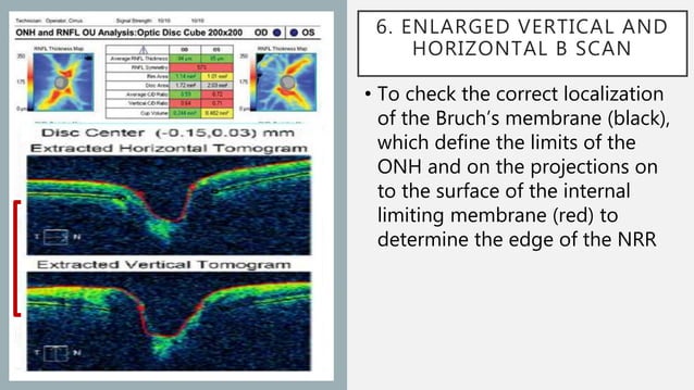 Imaging in Glaucoma | PPTX | Eye and Vision Conditions | Diseases and ...