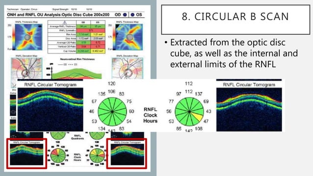 Imaging in Glaucoma | PPTX | Eye and Vision Conditions | Diseases and ...