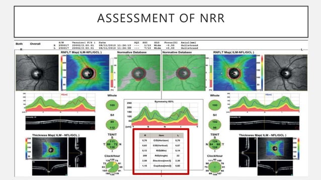 Imaging in Glaucoma | PPTX | Eye and Vision Conditions | Diseases and ...