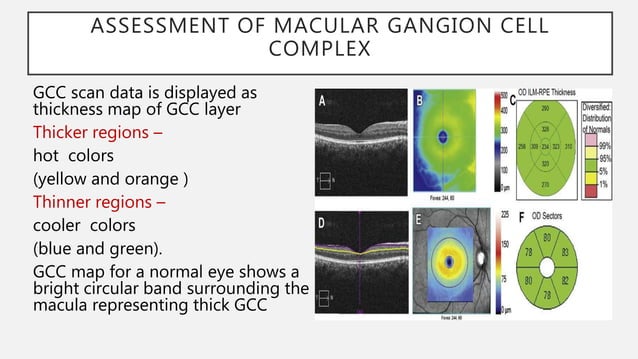 Imaging in Glaucoma | PPTX | Eye and Vision Conditions | Diseases and ...