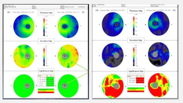 Imaging in Glaucoma | PPTX | Eye and Vision Conditions | Diseases and ...