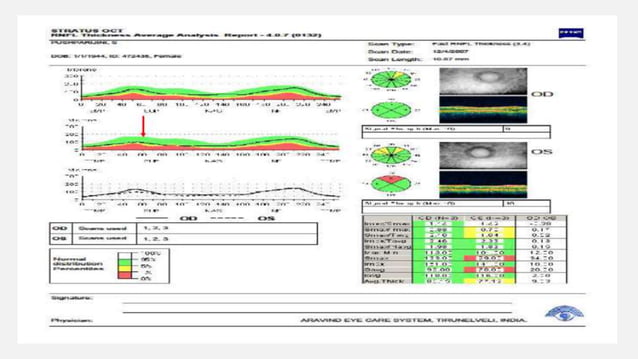 Imaging in Glaucoma | PPTX | Eye and Vision Conditions | Diseases and ...