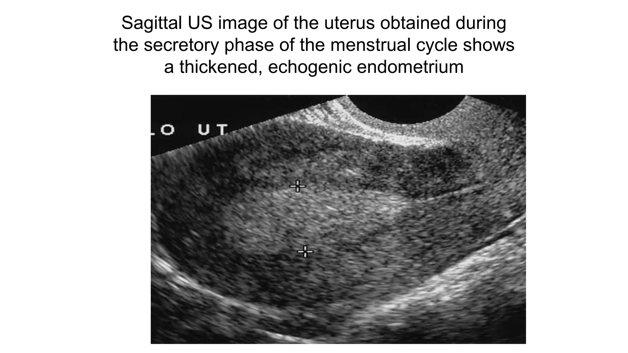 Imaging in gynaecology | PPTX