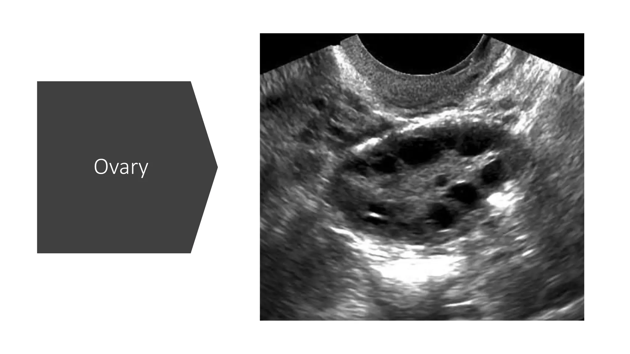 Imaging in gynaecology | PPTX