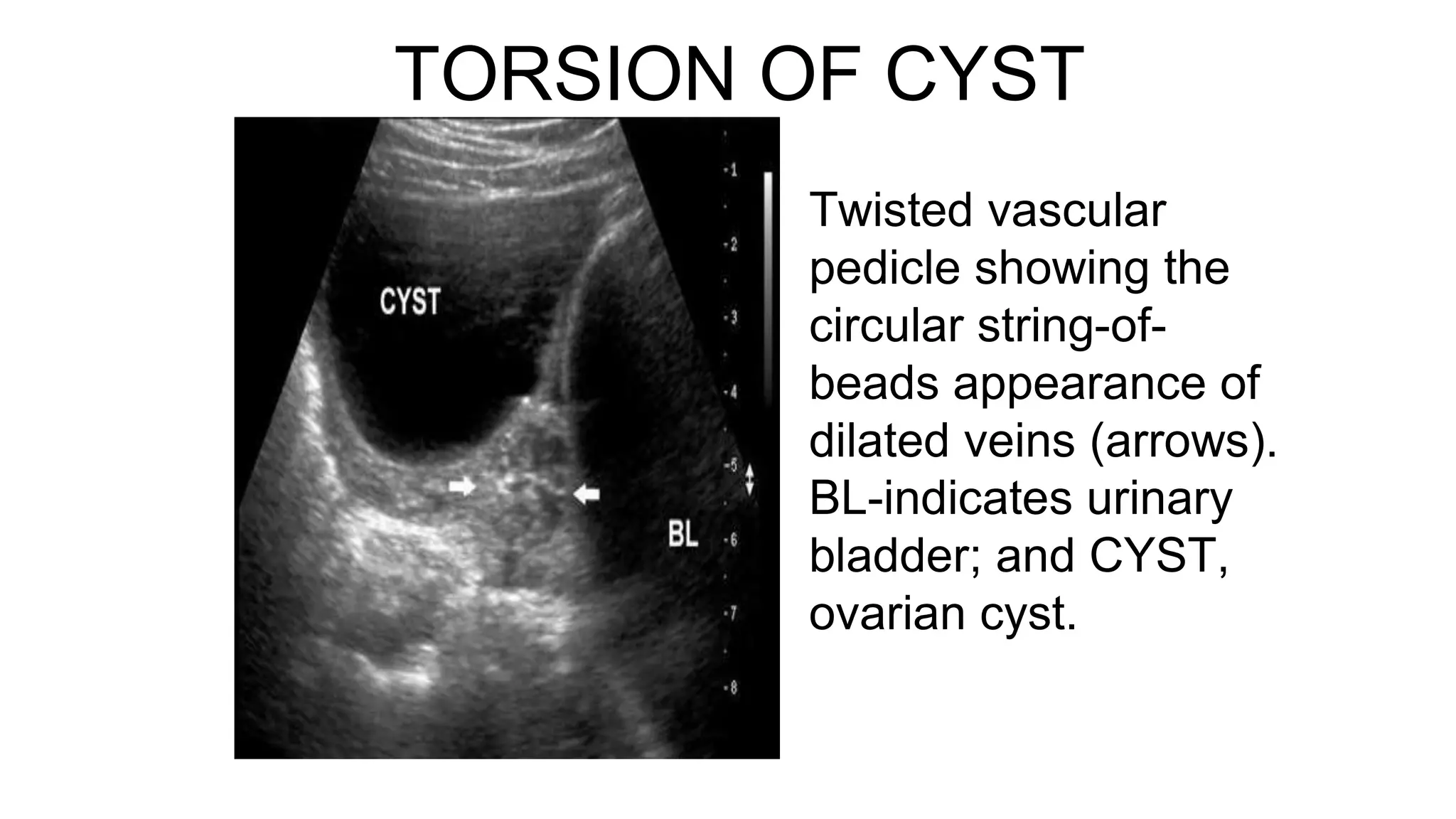 Imaging in gynaecology | PPTX