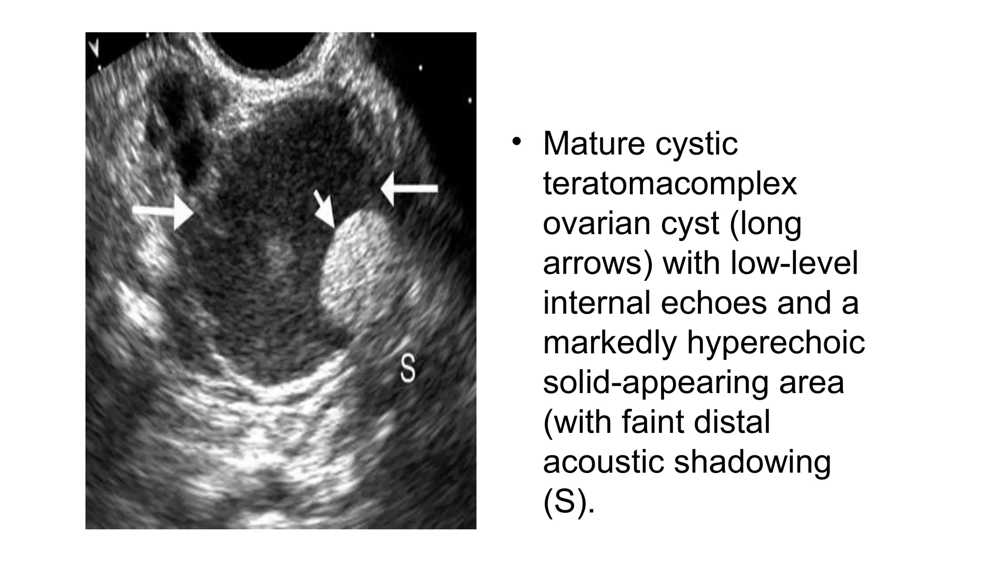 Imaging in gynaecology | PPTX