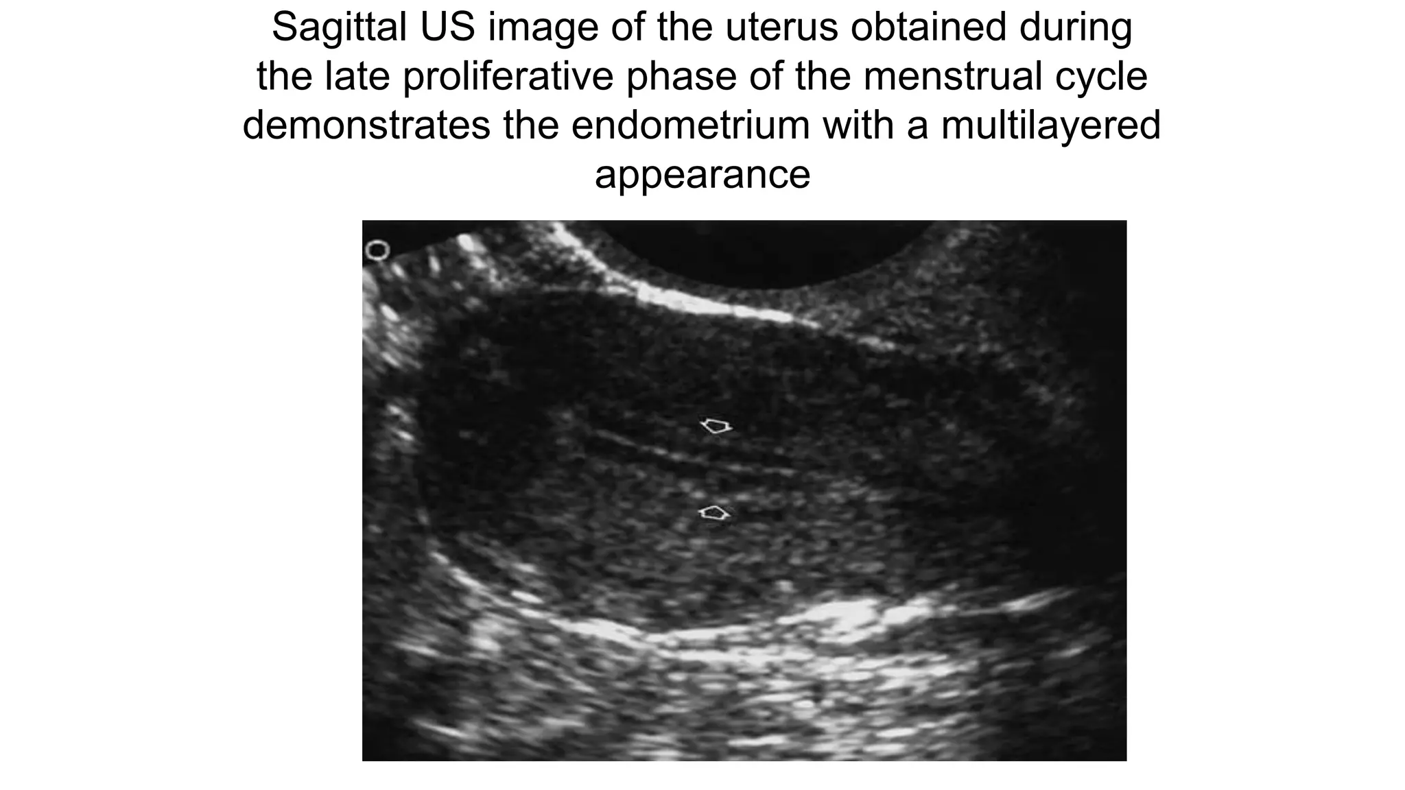 Imaging in gynaecology | PPTX